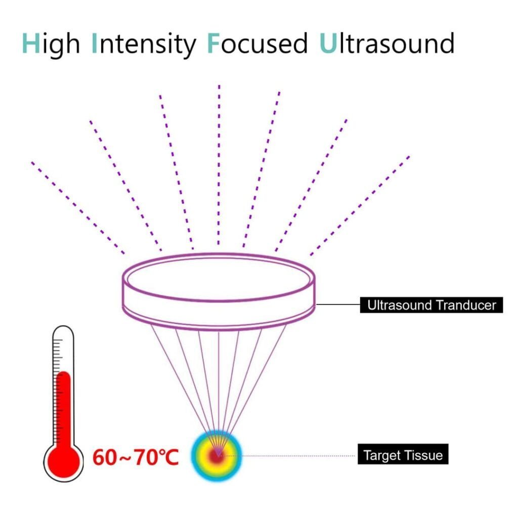 HIFU: High Intensity Focused Ultrasound Non-Surgical Therapy