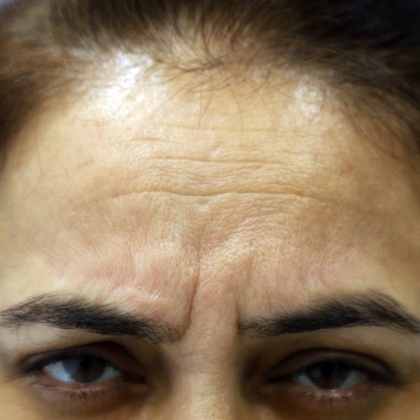 Botulinum Toxin Injection: Best Wrinkles Treatment of Face